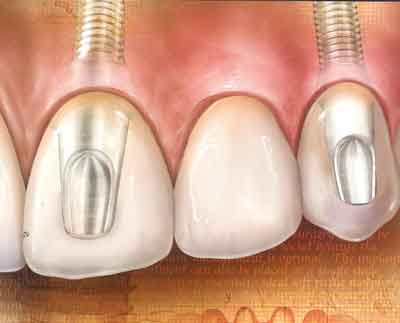 fixed prosthodontics at emaze Presentation