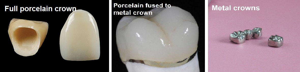 fixed prosthodontics at emaze Presentation