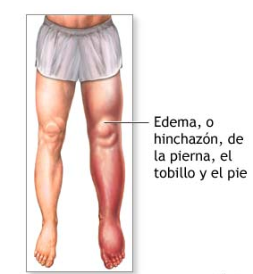 Inflamación aguda.pptx at emaze Presentation
