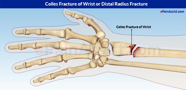 Colles' Fracture at emaze Presentation