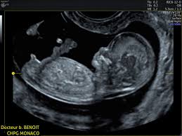 comment connaître si un foetus est mâle ou femelle, bien on emaze