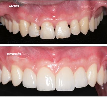 polividrios o on emaze