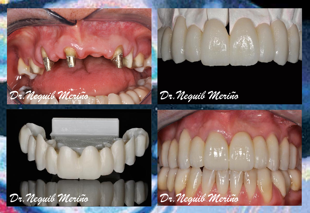 polividrios o on emaze