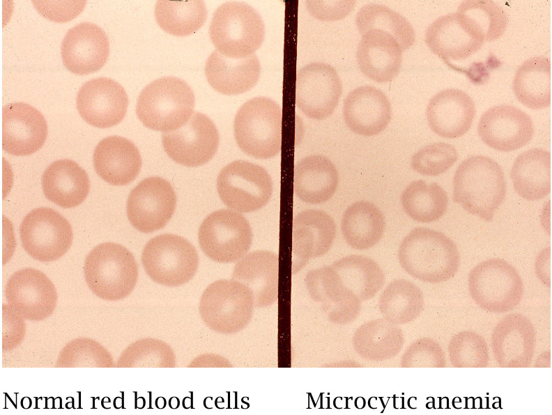 Anemia at emaze Presentation