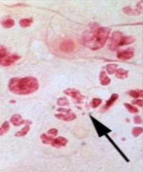 Chancroide at emaze Presentation