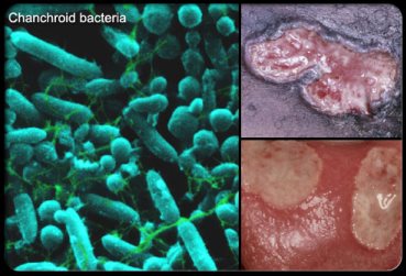 Chancroide at emaze Presentation