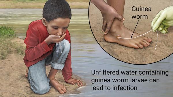 Dracunculiasis on emaze