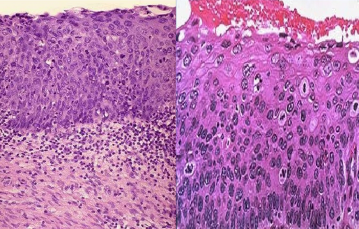 Neoplasias on emaze