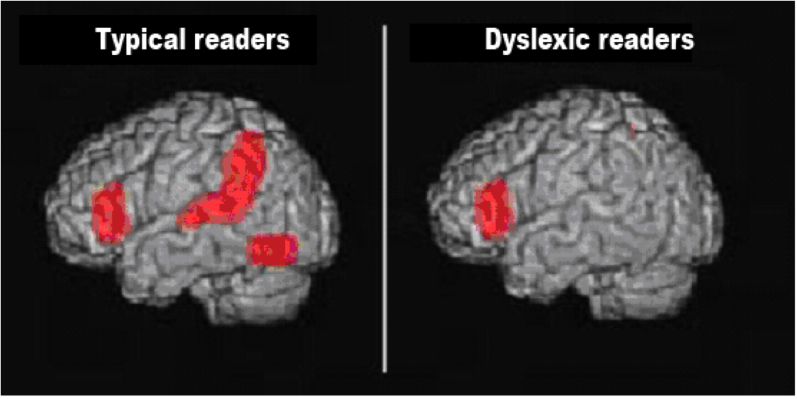 Dyslexia PPT on emaze