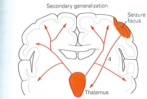 Aias neuro, crisis convulsiva on emaze