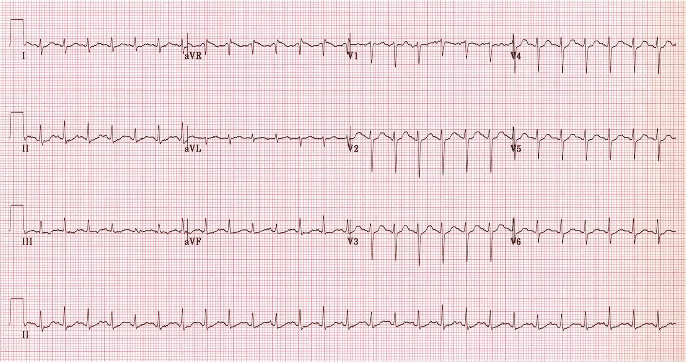 ECG on emaze