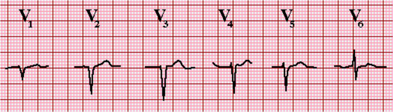 ECG on emaze