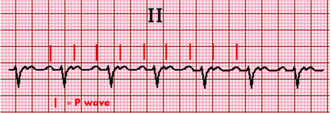 ECG on emaze