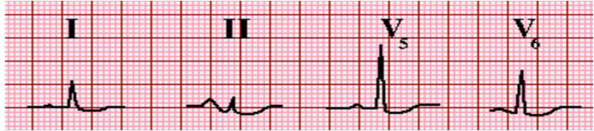 ECG on emaze