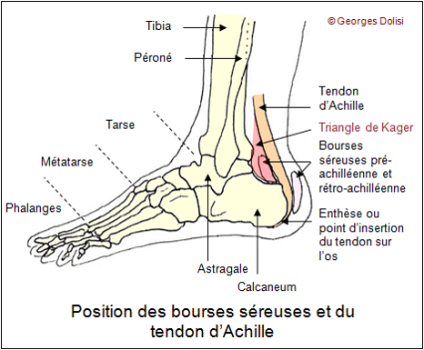 Chronic rupures of the achilles tendon on emaze