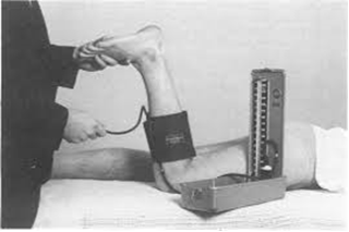 Chronic rupures of the achilles tendon on emaze