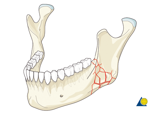 Fracturas Mandibulares.pptx at emaze Presentation