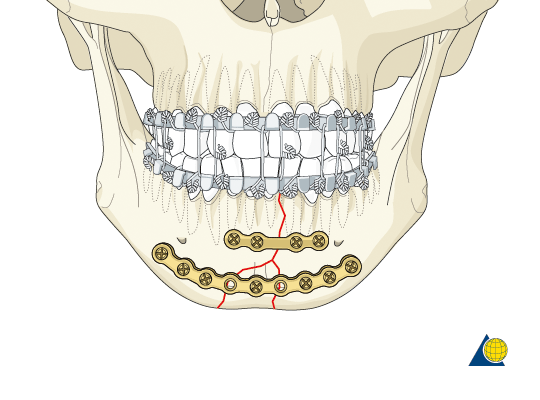 Fracturas Mandibulares.pptx on emaze