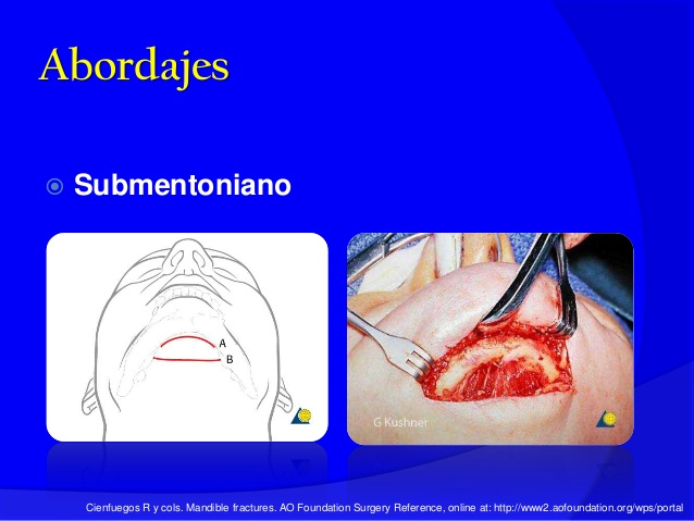 Fracturas Mandibulares.pptx on emaze