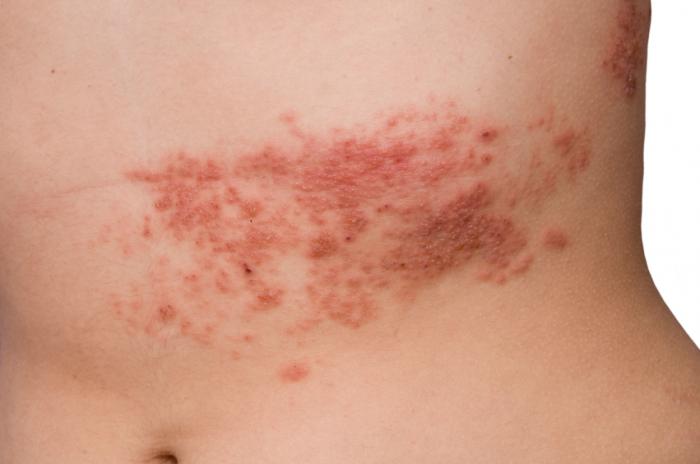 shingles at emaze Presentation