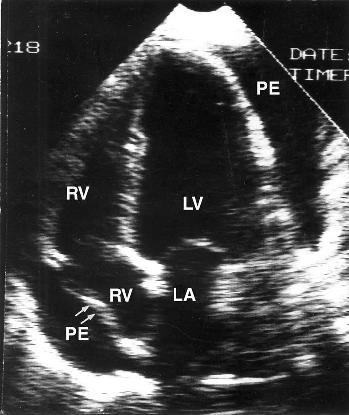 Cardiac Tamponade on emaze