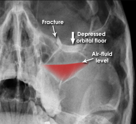 Facial Bones Xray tutorial on emaze