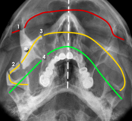 Facial Bones Xray tutorial at emaze Presentation