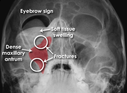 Facial Bones Xray tutorial on emaze