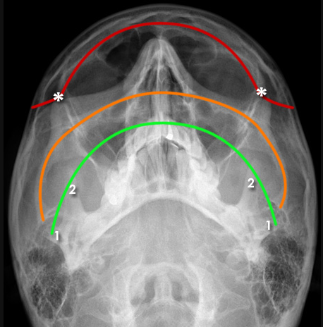 Facial Bones Xray tutorial on emaze