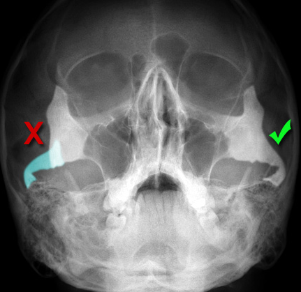 Facial Bones Xray tutorial on emaze