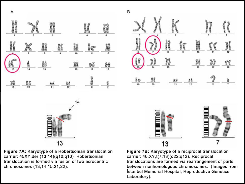 Trisomy 13Trisomy 13 on emaze
