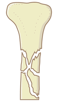 Serrated Fracture Definition