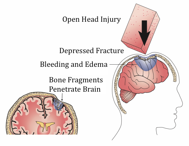 traumatic brain injury at emaze Presentation