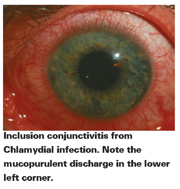BACTERIAL CONJUNCTIVAL INFECTIONS.pptx at emaze Presentation