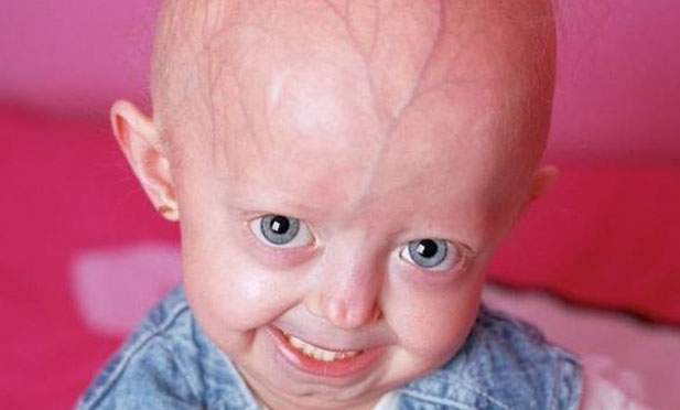 Progeria at emaze Presentation