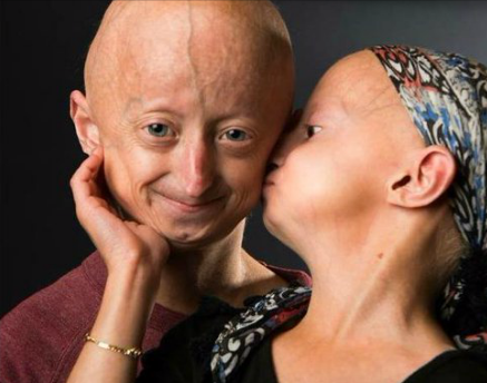 Progeria at emaze Presentation