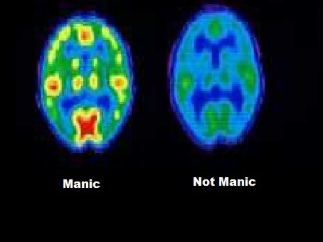 Neurotransmitters In The Brain Bipolar Disorder