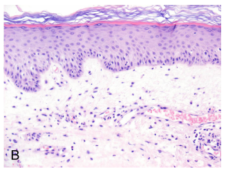 vulva swelling in cyclist at emaze Presentation