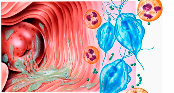 TRICOMONIASIS on emaze