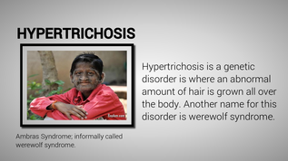 hypertrichosis at emaze Presentation