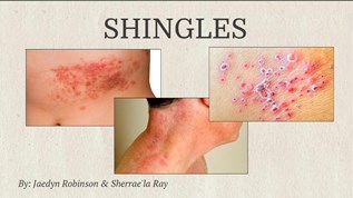 Shingles at emaze Presentation