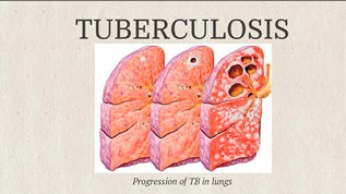 Tuberculosis at emaze Presentation