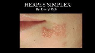 HERPIES SIMPLEX at emaze Presentation