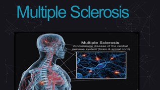 Multiple Sclerosis at emaze Presentation