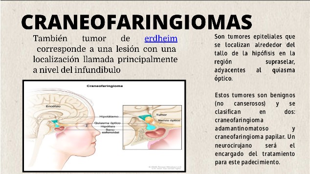 CRANEOFARINGIOMA at emaze Presentation