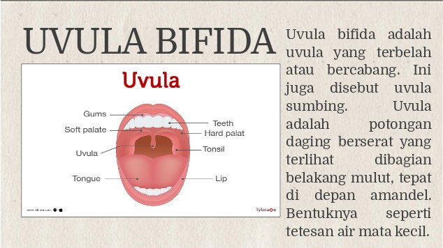 UVULA BIFIDA at emaze Presentation