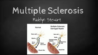 Multiple Sclerosis at emaze Presentation