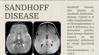 Sandhoff disease, at emaze Presentation
