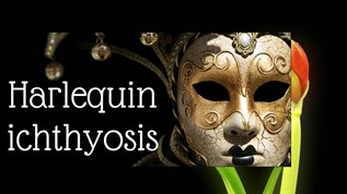 Harlequin-type ichthyosis at emaze Presentation