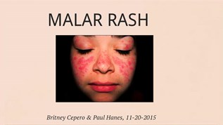 Malar Rash on emaze